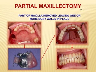 Maxillectomy | PPTX