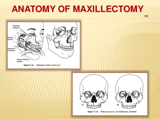 Maxillectomy