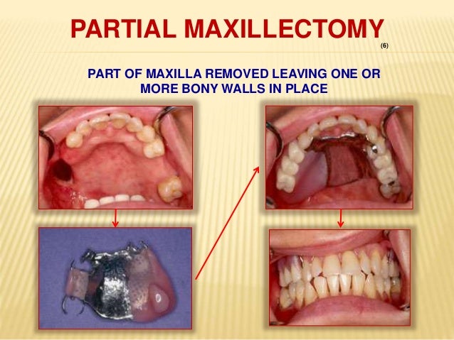 Maxillectomy