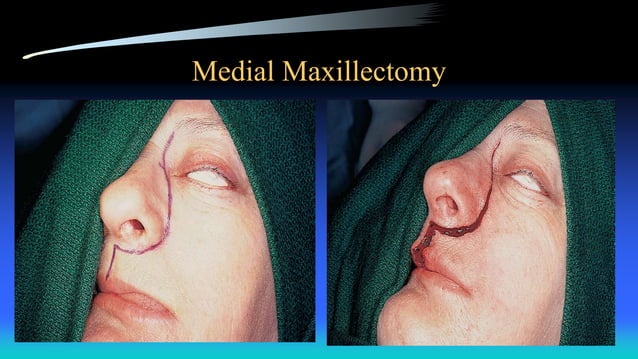 Maxillectomy and craniofacial resection | PPTX | Ear, Nose and Throat ...