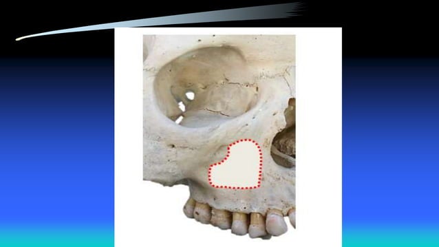 Maxillectomy and craniofacial resection | PPTX | Ear, Nose and Throat ...