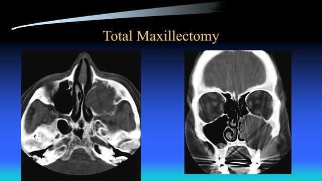 Maxillectomy and craniofacial resection | PPTX | Ear, Nose and Throat ...