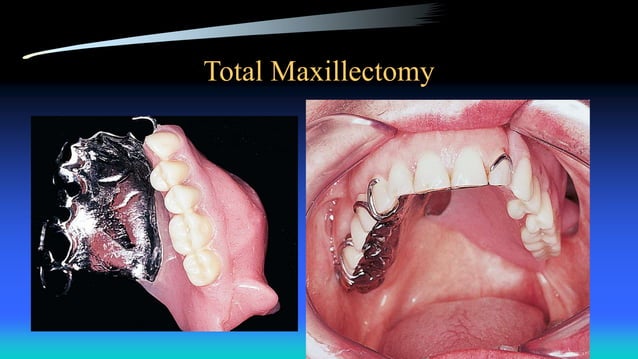 Maxillectomy and craniofacial resection | PPTX | Ear, Nose and Throat ...