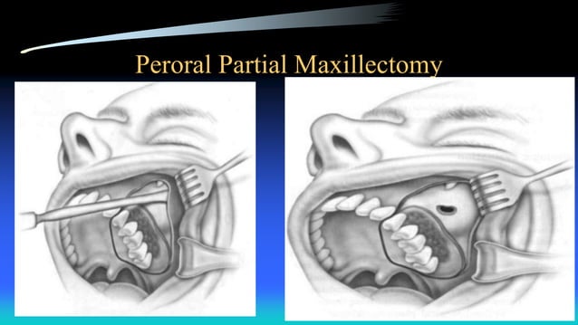 Maxillectomy and craniofacial resection | PPTX | Ear, Nose and Throat ...