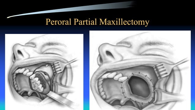 Maxillectomy and craniofacial resection | PPTX | Ear, Nose and Throat ...