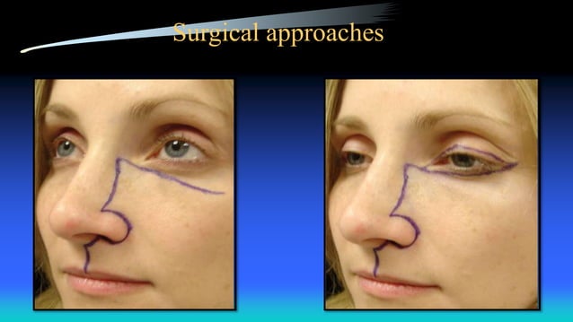 Maxillectomy and craniofacial resection | PPTX | Ear, Nose and Throat ...