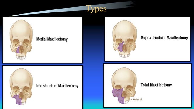 Maxillectomy and craniofacial resection