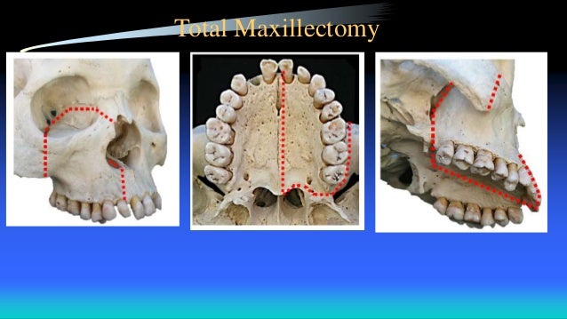Maxillectomy and craniofacial resection