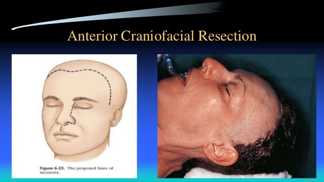 Maxillectomy and craniofacial resection