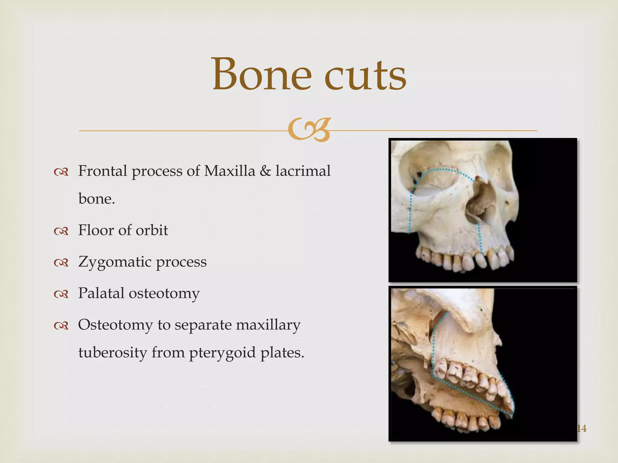 Maxillectomy & Rehabilitation | PPSX