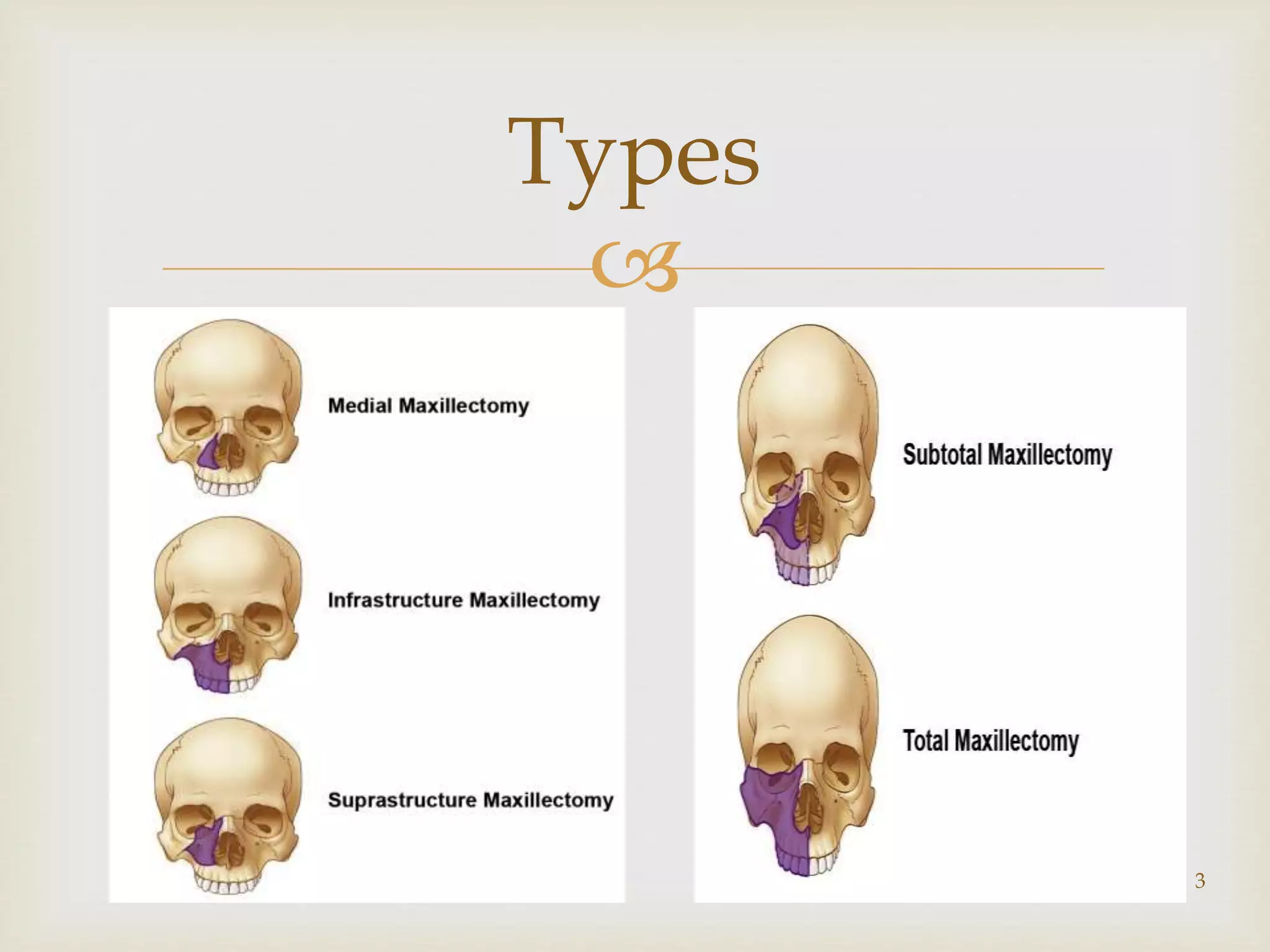 Maxillectomy & Rehabilitation | PPSX