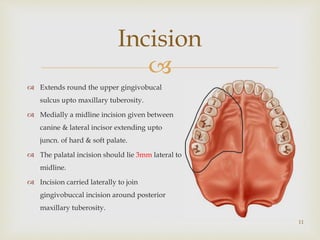 Maxillectomy & Rehabilitation | PPSX