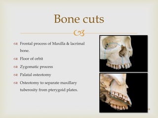 Maxillectomy & Rehabilitation | PPSX