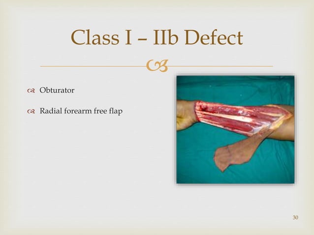 Maxillectomy & Rehabilitation | PPSX | Ear, Nose and Throat Conditions ...