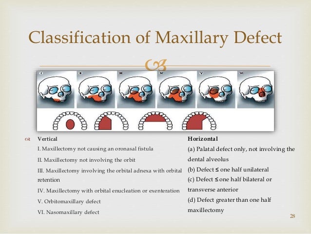 Maxillectomy & Rehabilitation