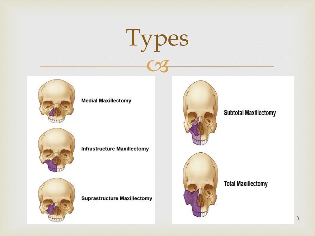 Maxillectomy & Rehabilitation