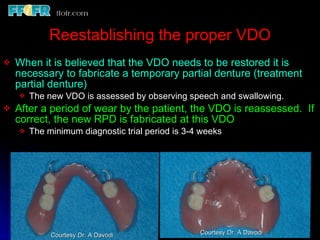 Maxillo mandibular records | PPT