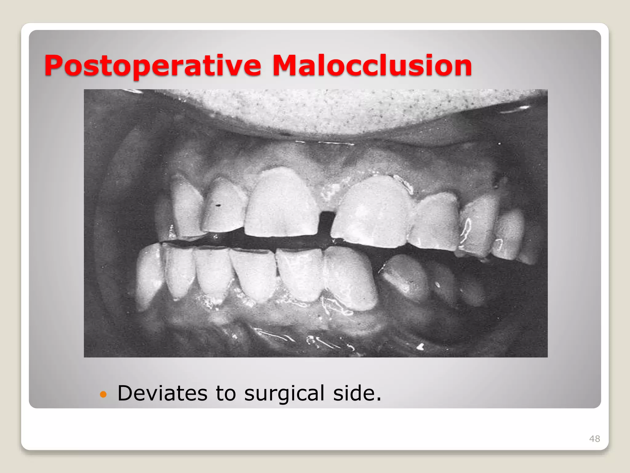 Maxillofacial prosthesis | PPTX