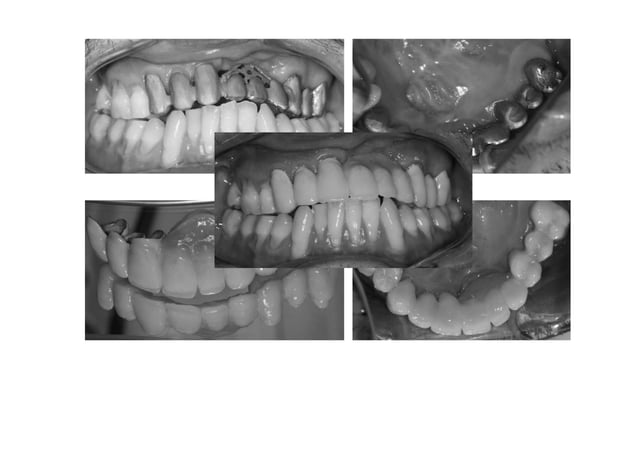 Maxillofacial-prosthetics.pdf
