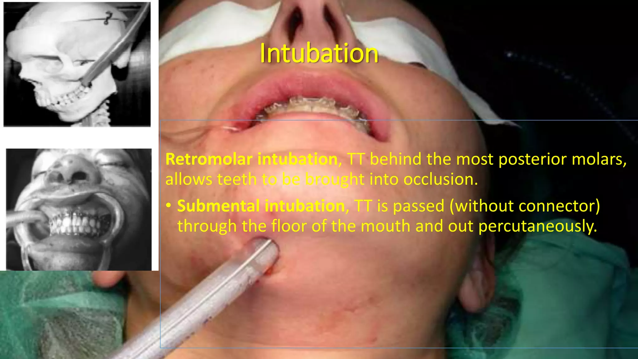 Maxillofacial surgery and anesthetic issues | PPTX