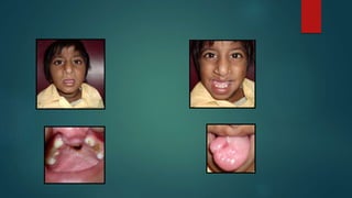 MAXILLOFACIAL 2.pptx | Dental Health | Diseases and Conditions