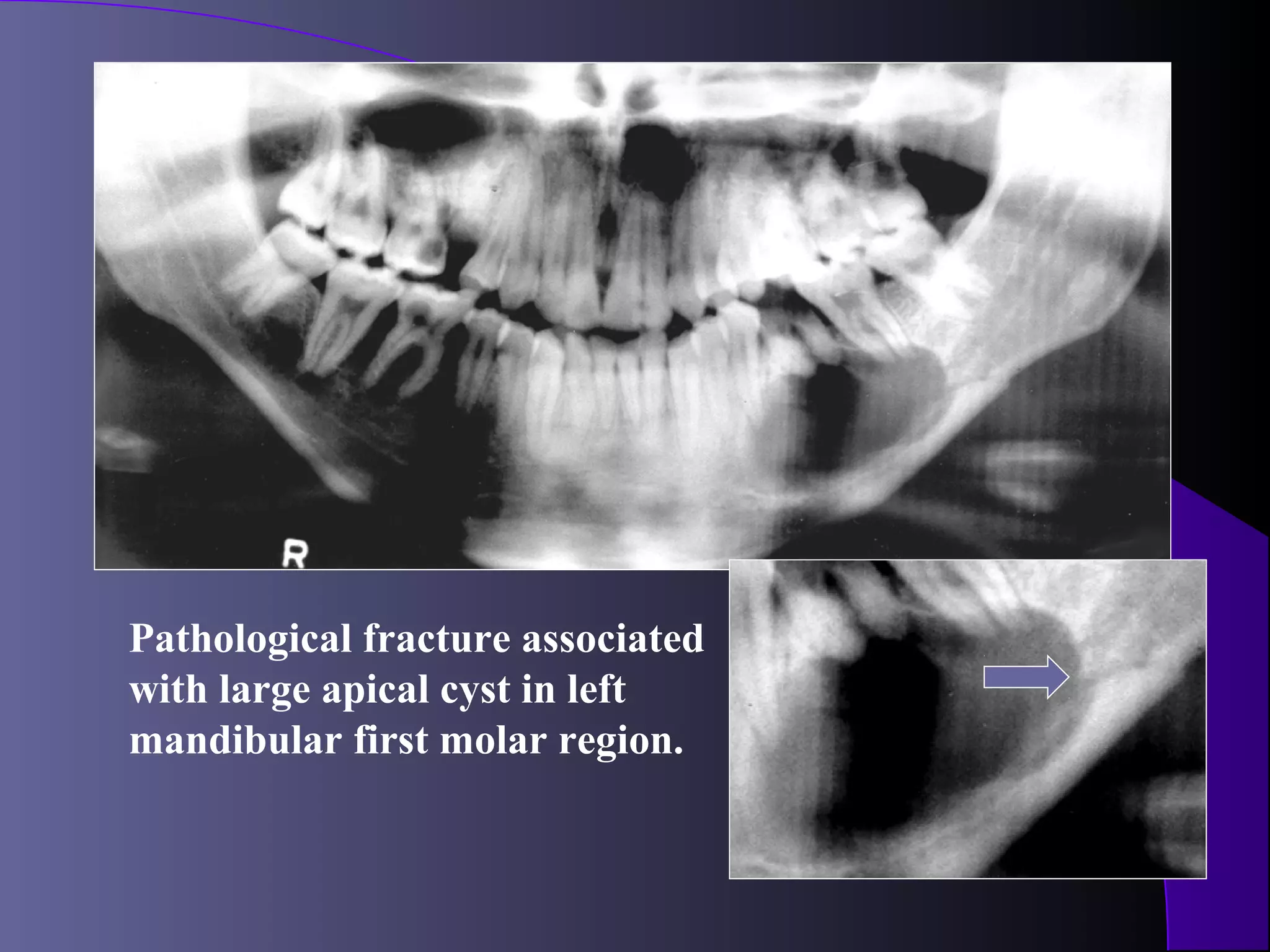 Maxillofacial fractures | PPT