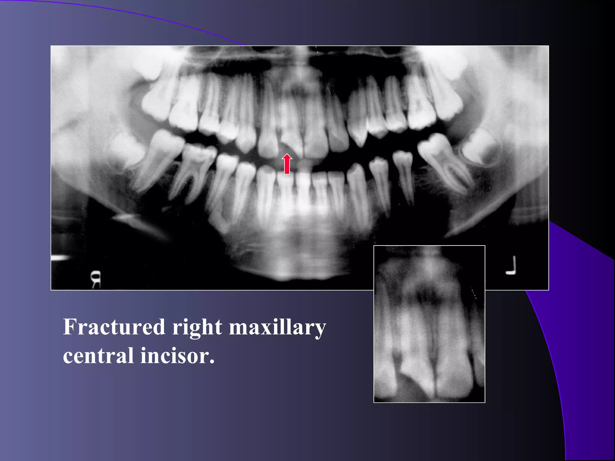 Maxillofacial fractures | PPT