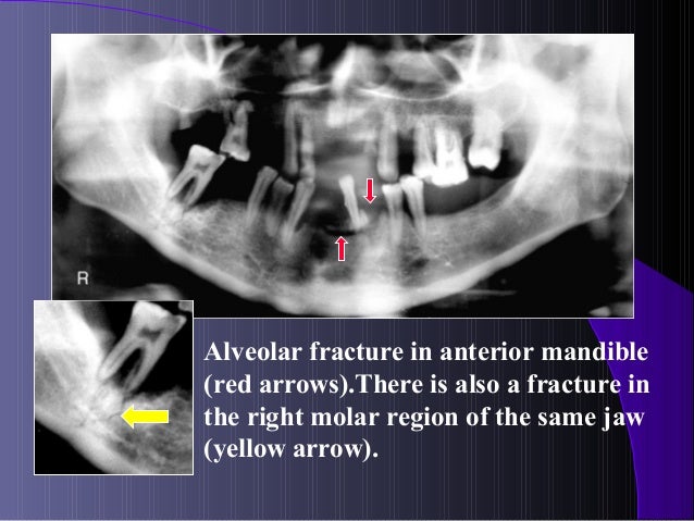 Maxillofacial fractures