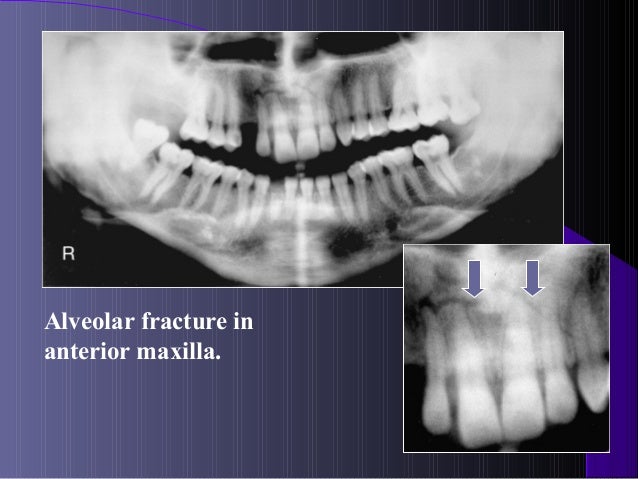 Maxillofacial fractures