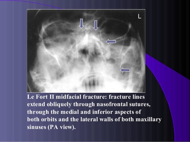 Maxillary And Le Fort Fractures – LMTYW
