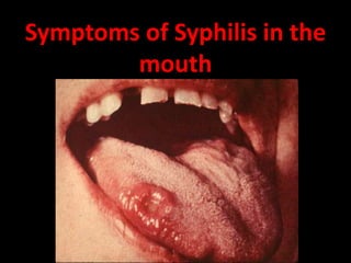 Maxillofacial infections | PPSX