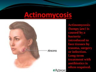 Maxillofacial infections | PPSX
