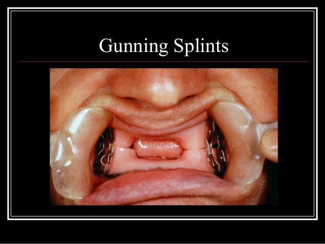 Maxillofacial injuries