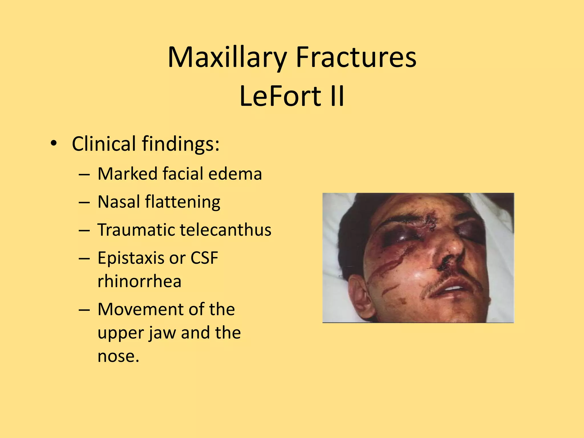 Maxillofacial injuries | PPTX