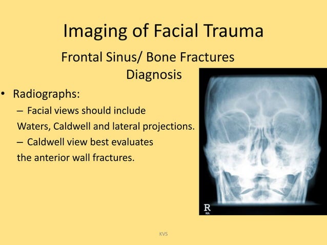 Maxillofacial injuries | PPTX