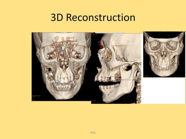 Maxillofacial injuries | PPTX