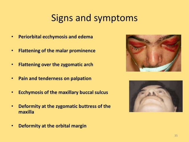 Maxillofacial injuries | PPTX