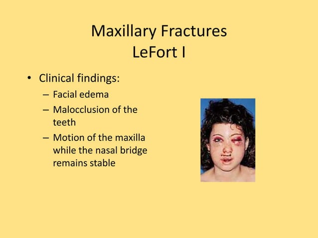 Maxillofacial injuries | PPTX