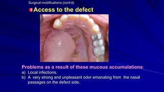 maxillofacial prosth..pptx