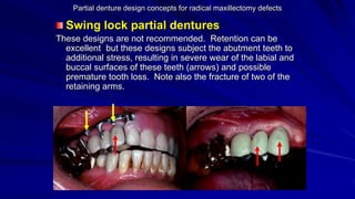 maxillofacial prosth..pptx