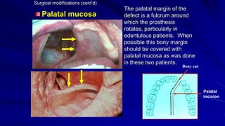 maxillofacial prosth..pptx