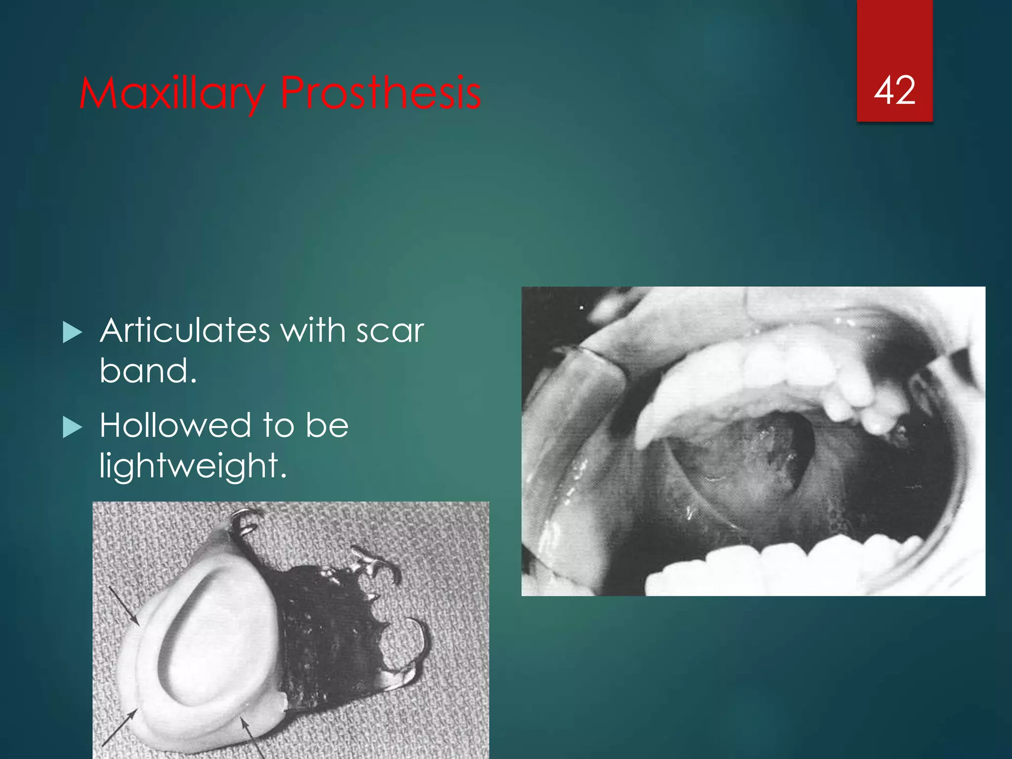 Maxillo facial prosthesis | PPTX