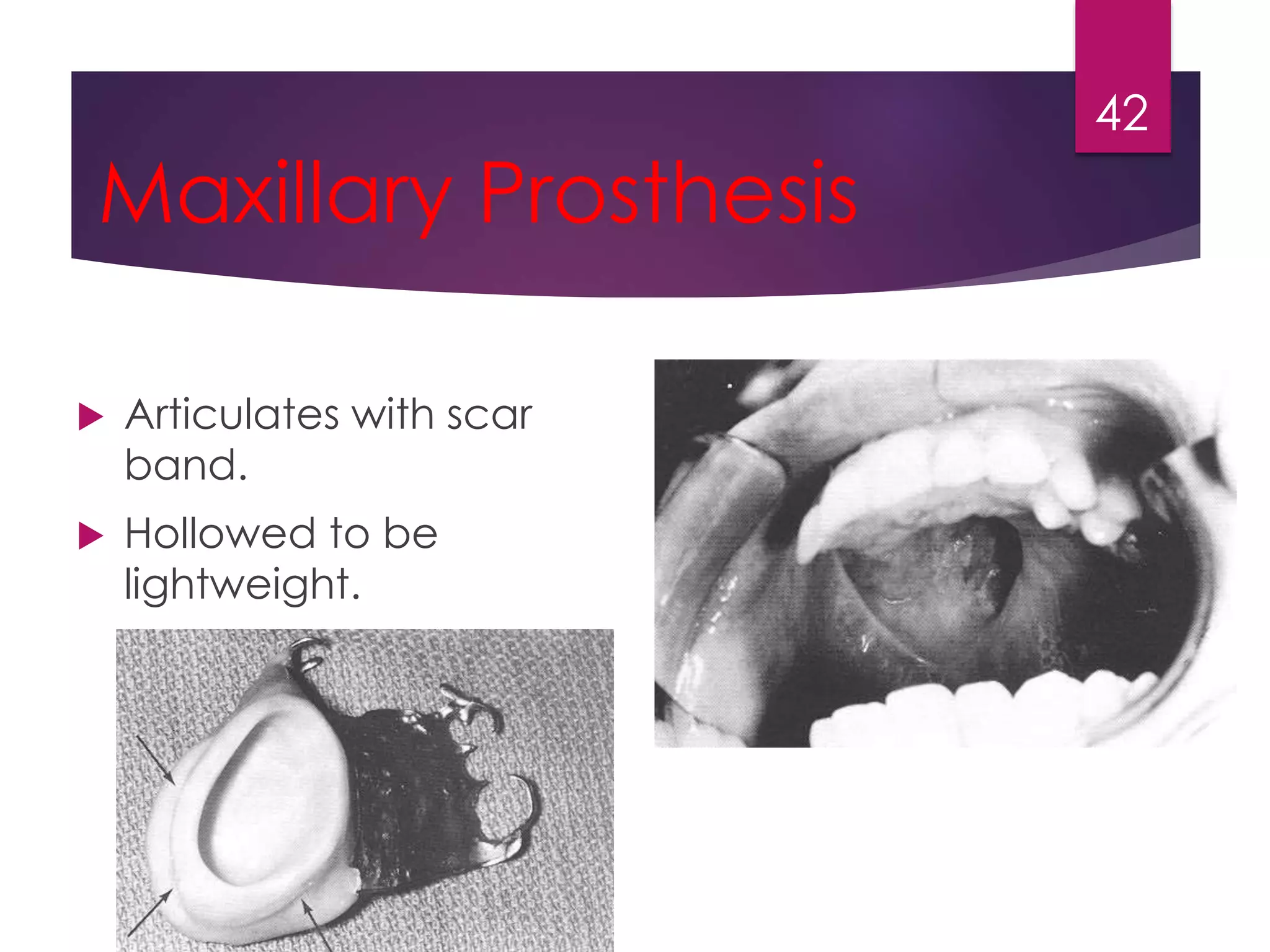 Maxillofacial prosthesis | PPTX