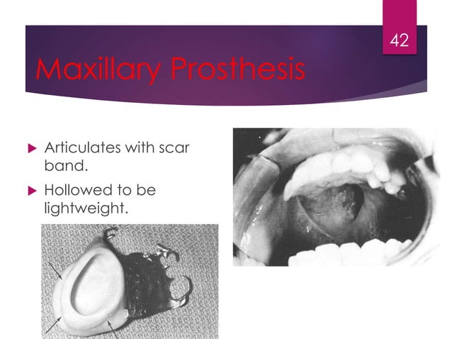 Maxillofacial prosthesis | PPTX | Ear, Nose and Throat Conditions ...