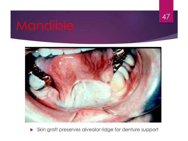 Maxillofacial prosthesis | PPTX | Ear, Nose and Throat Conditions ...