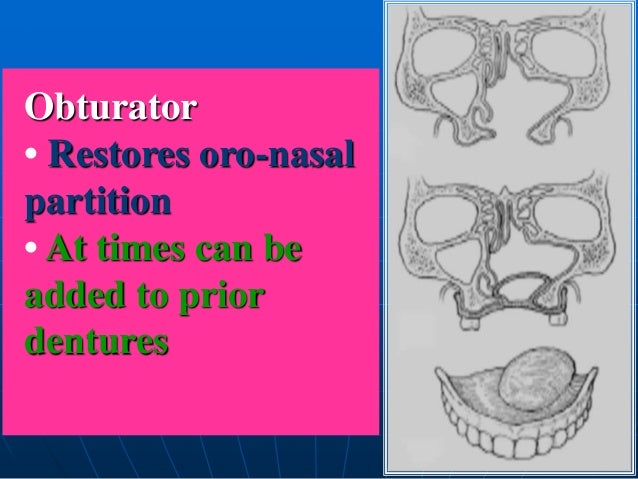 Maxillofacial prosthesis