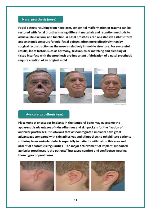 Maxillofacial Prosthesis | PDF