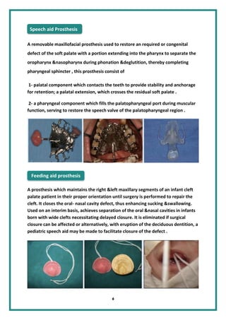 Maxillofacial Prosthesis | PDF