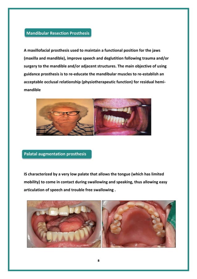 Maxillofacial Prosthesis | PDF
