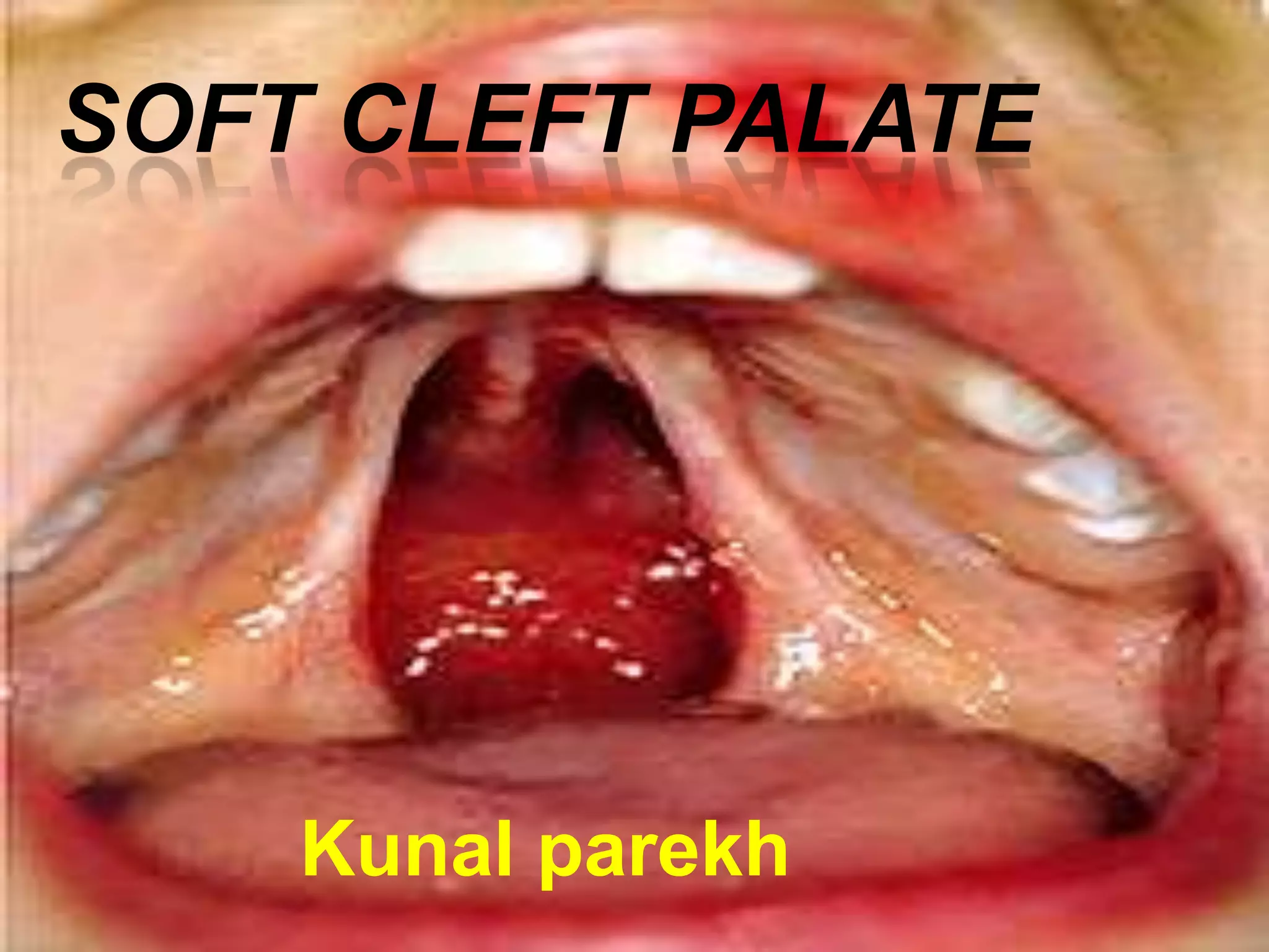 Maxillofacial prosthesis of soft cleft palate | PPTX